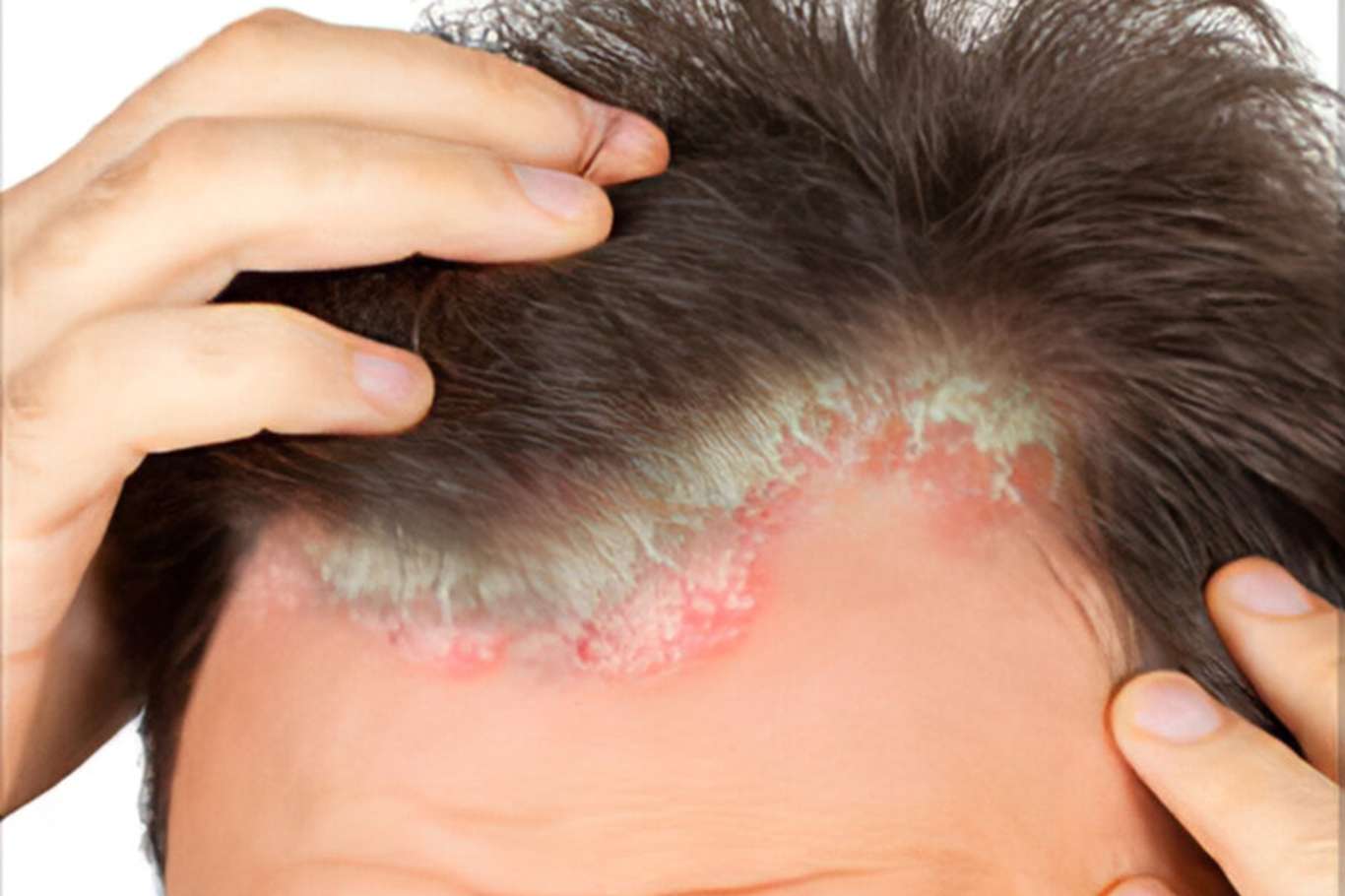 Sedef hastalığı neden olur? | MersinMedia